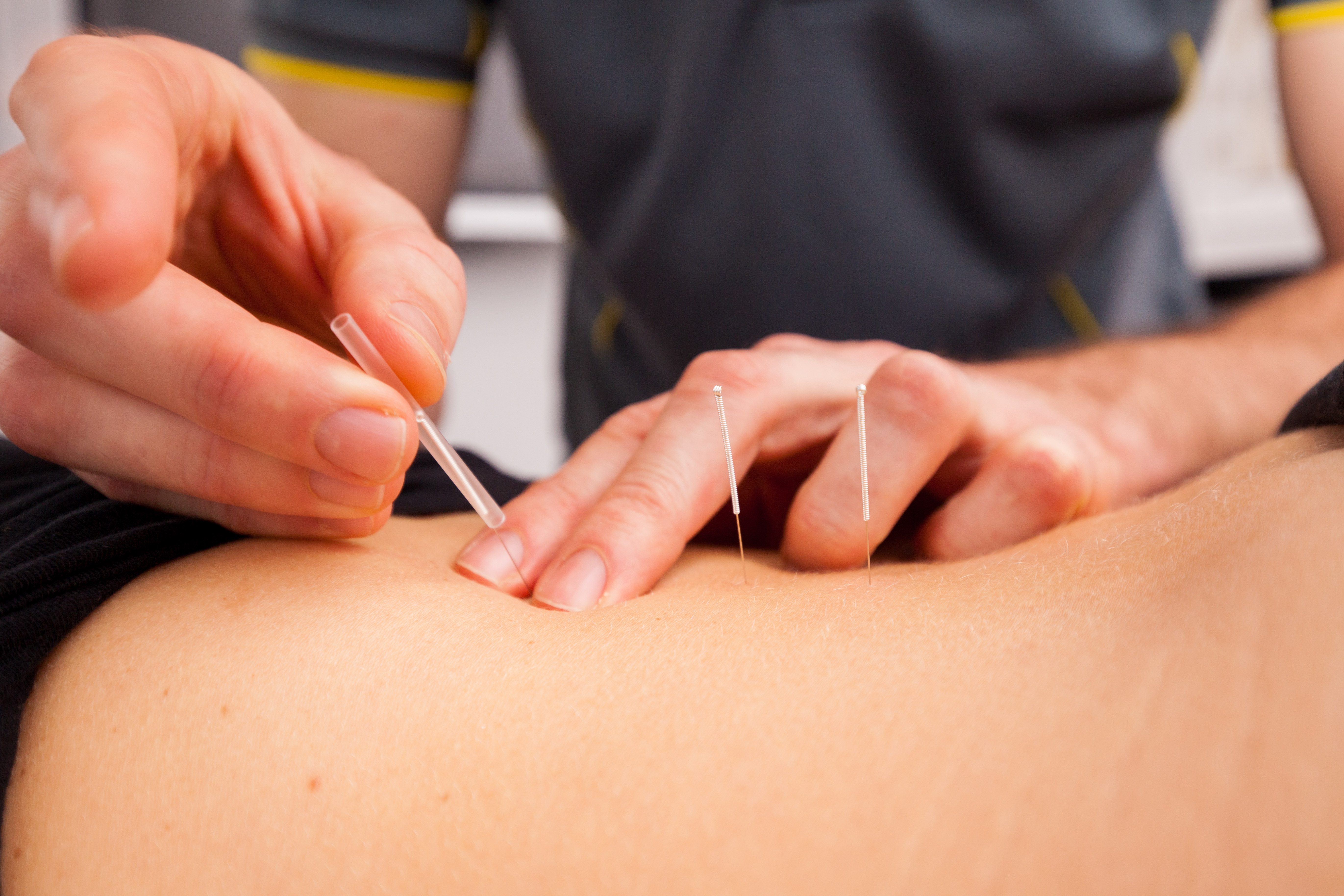 Acupuncture - Vivian Street Osteopaths